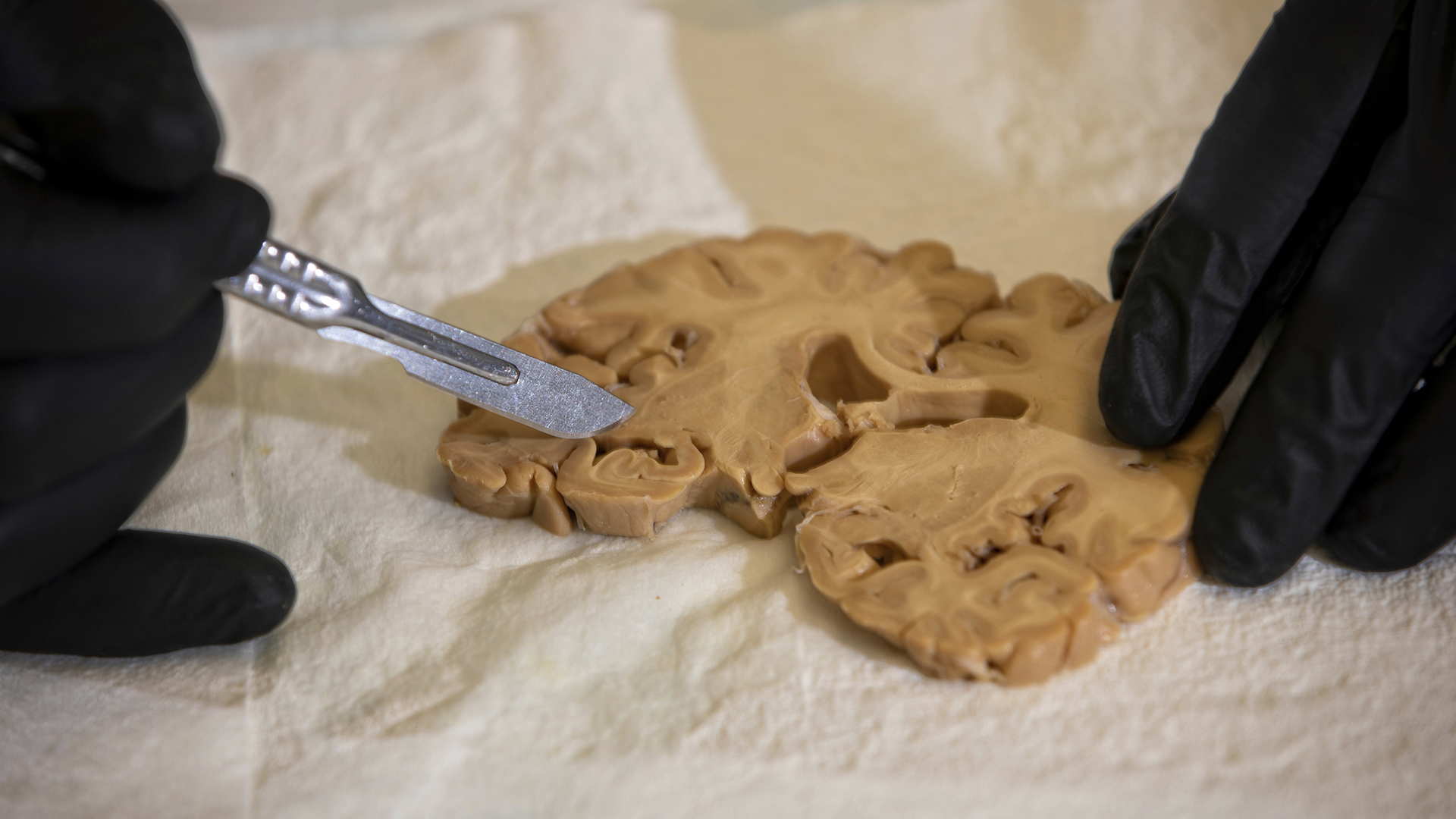 It Seems Like Alzheimer’s But Peek Into Brain Shows a Mimic | Chicago ...